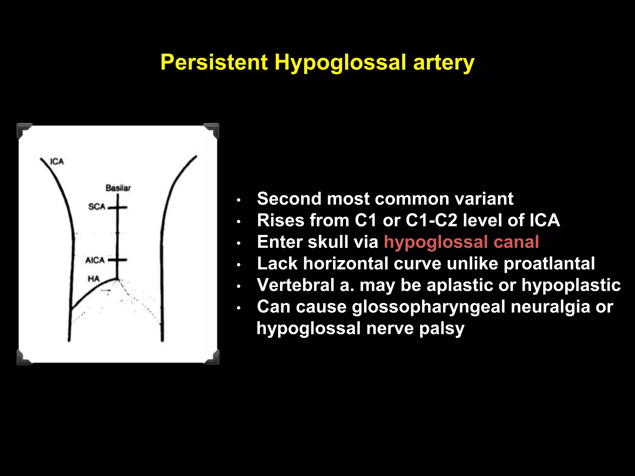 Carotid vertebral anastomosis | PPTX