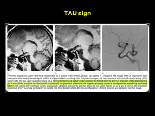 Carotid vertebral anastomosis | PPTX