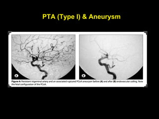 Carotid vertebral anastomosis | PPTX