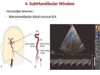 Carotid and transcranial duplex complete examination | PPTX