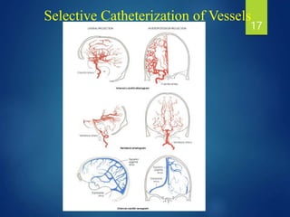 CAROTID AND VERTEBRAL ANGIOGRAPHY.pptx