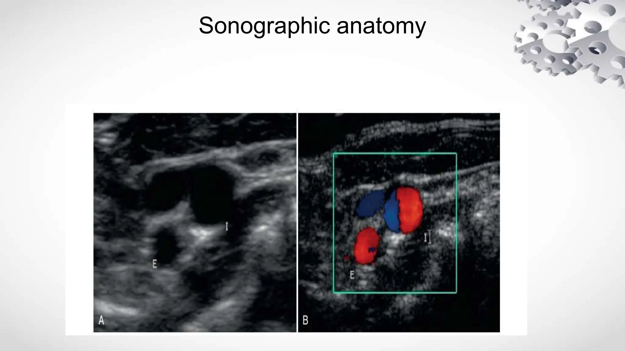 CAROTID Arteries Doppler ultrasound By JALIL HANAFI.pptx