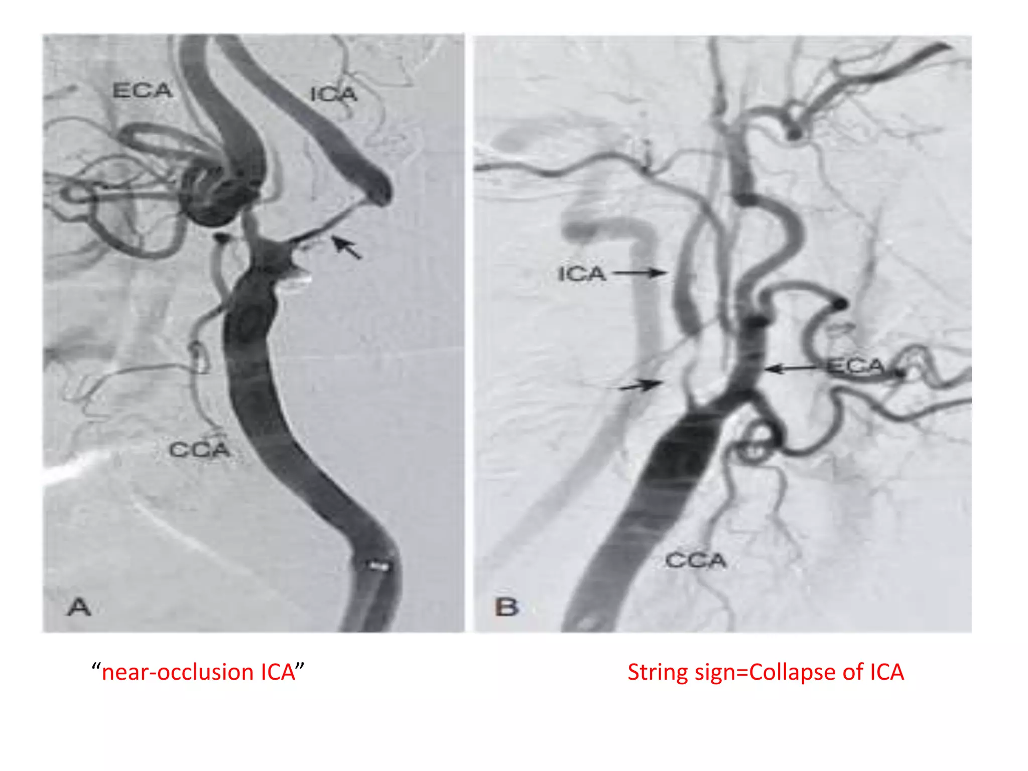 Carotid artery diseases and carotid stenting | PPTX
