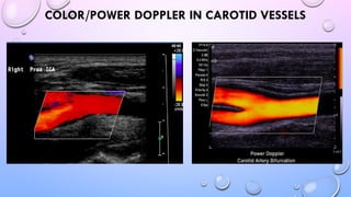 Carotid Doppler Ultrasound: Principles and Pitfalls | PPTX