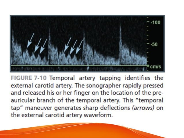 Carotid artery doppler study abdul | PPT
