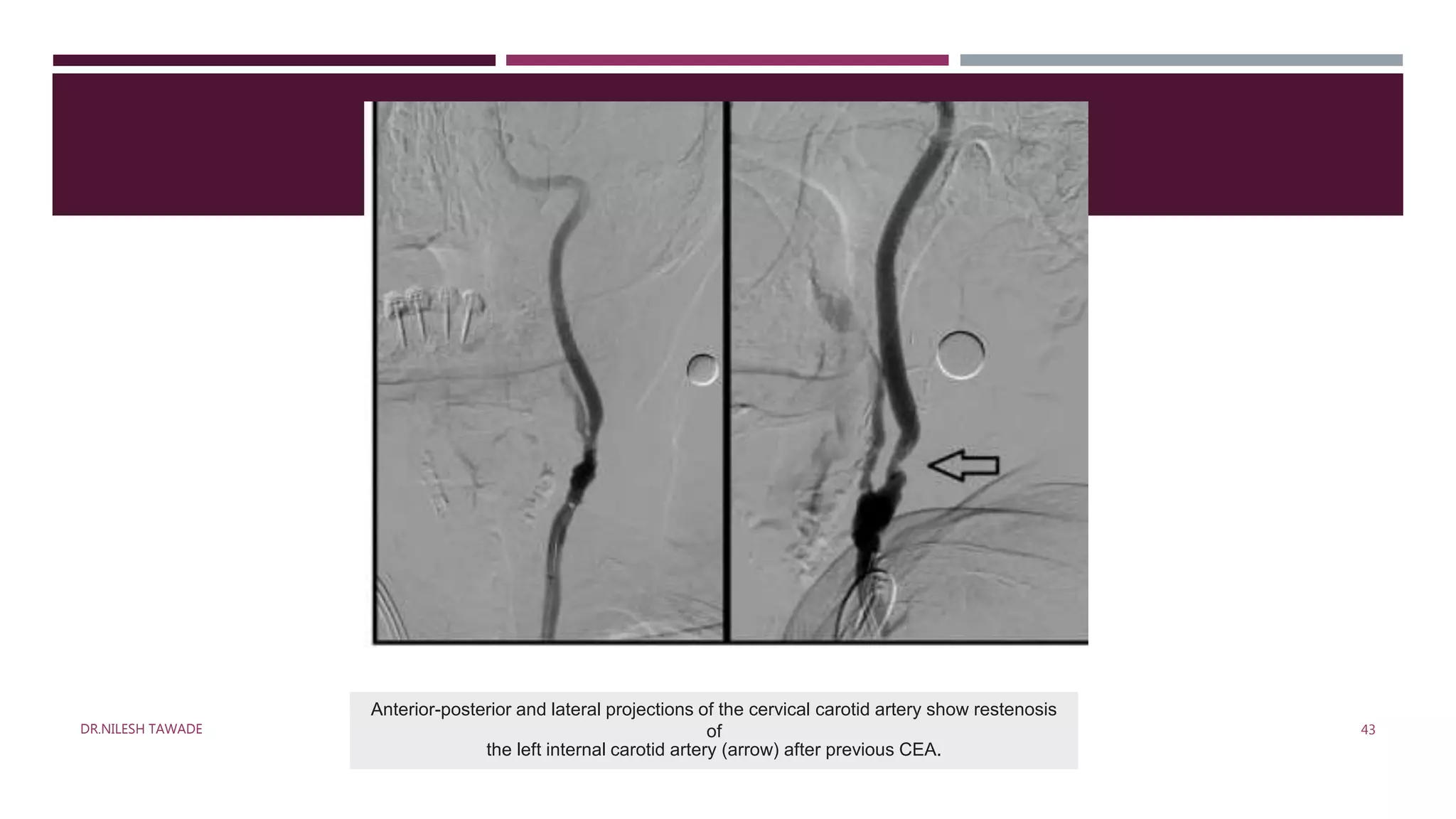 Carotid artery stenting basics | PPTX