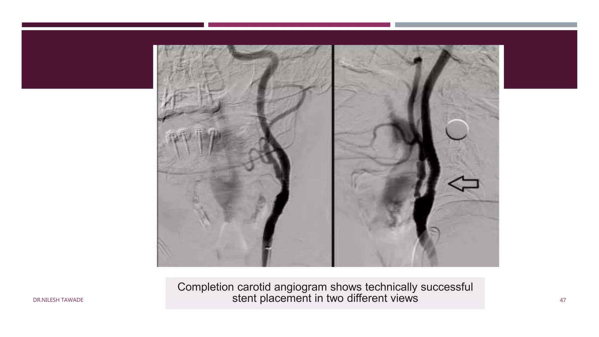 Carotid artery stenting basics | PPTX