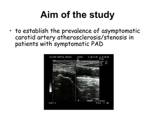 Carotid atherosclerosis in patients with PAD | PPT