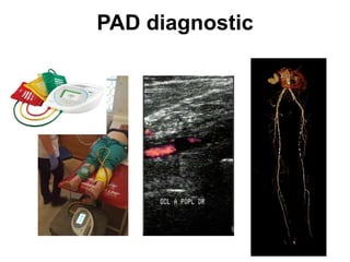 Carotid atherosclerosis in patients with PAD | PPT