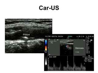 Carotid atherosclerosis in patients with PAD | PPT