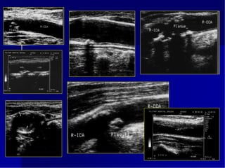 Carotid atherosclerosis in patients with PAD | PPT