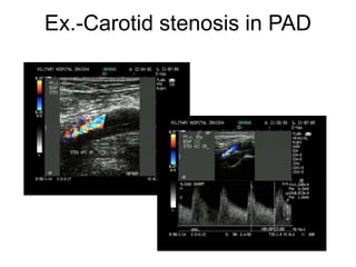 Carotid atherosclerosis in patients with PAD | PPT