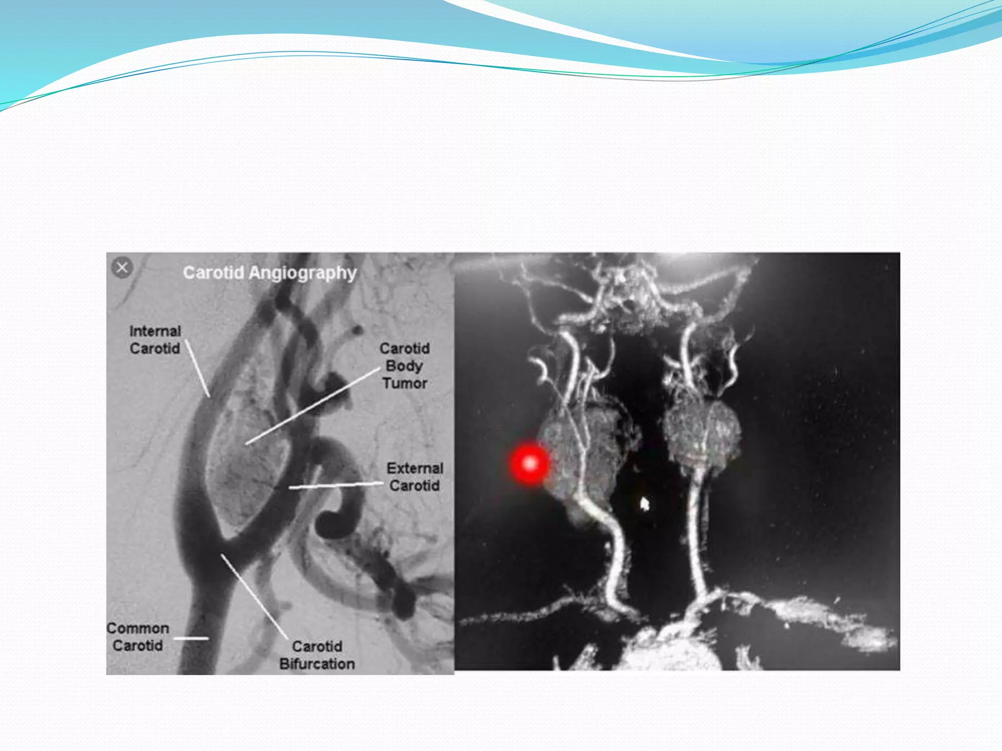 carotid body tumor.pptx