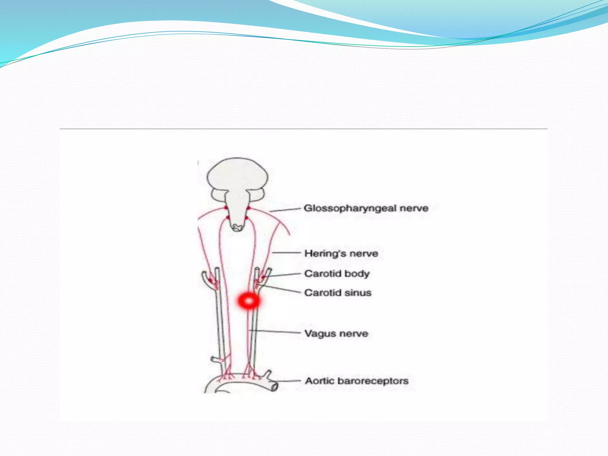 carotid body tumor.pptx