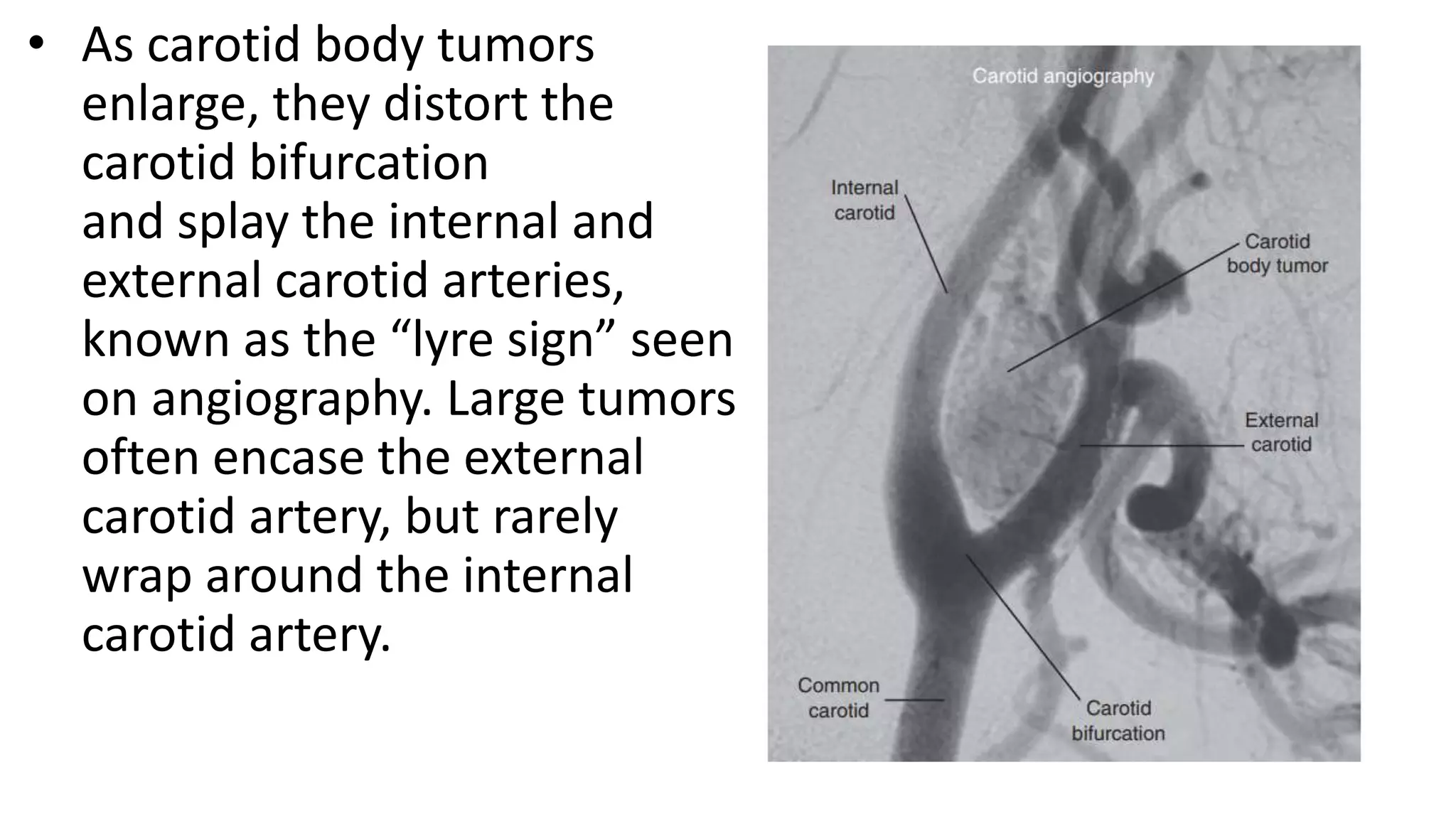 Carotid body tumors | PPTX