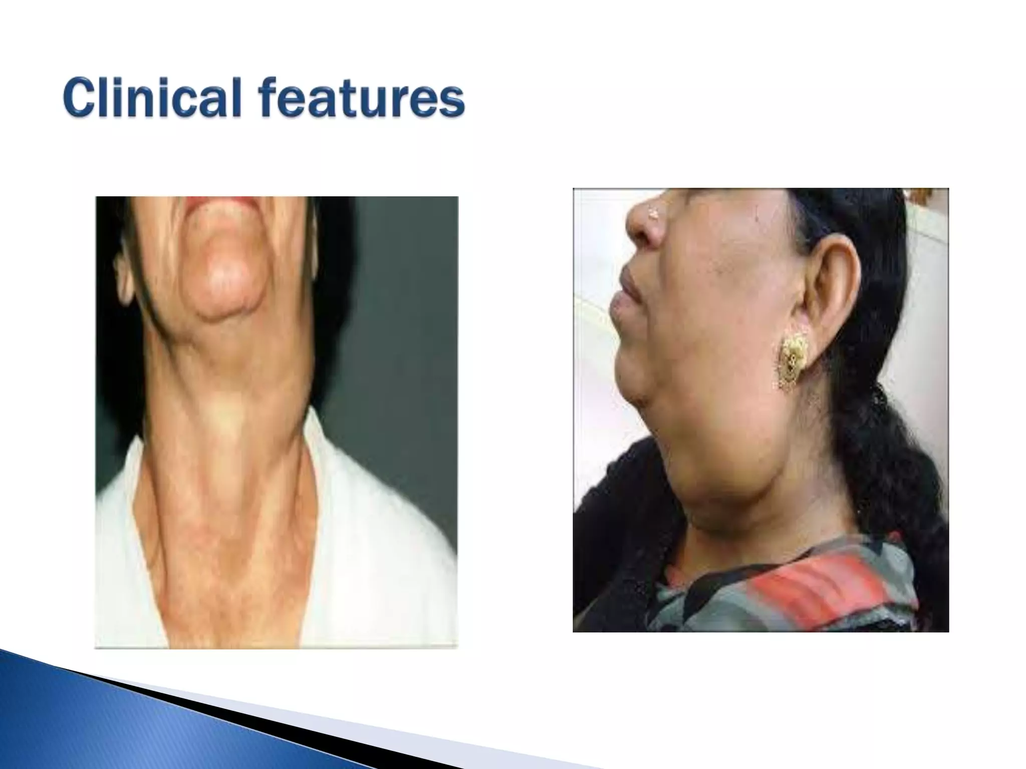 Carotid body tumour | PPTX