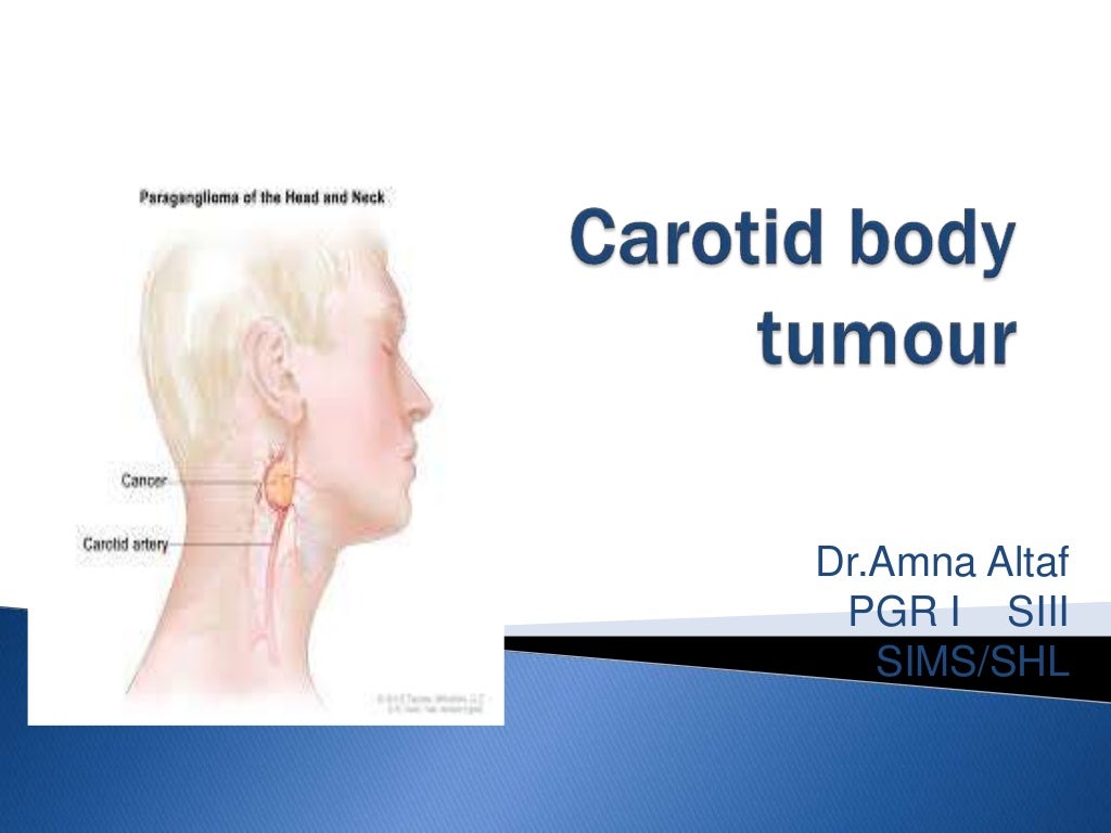 Carotid Body Tumour