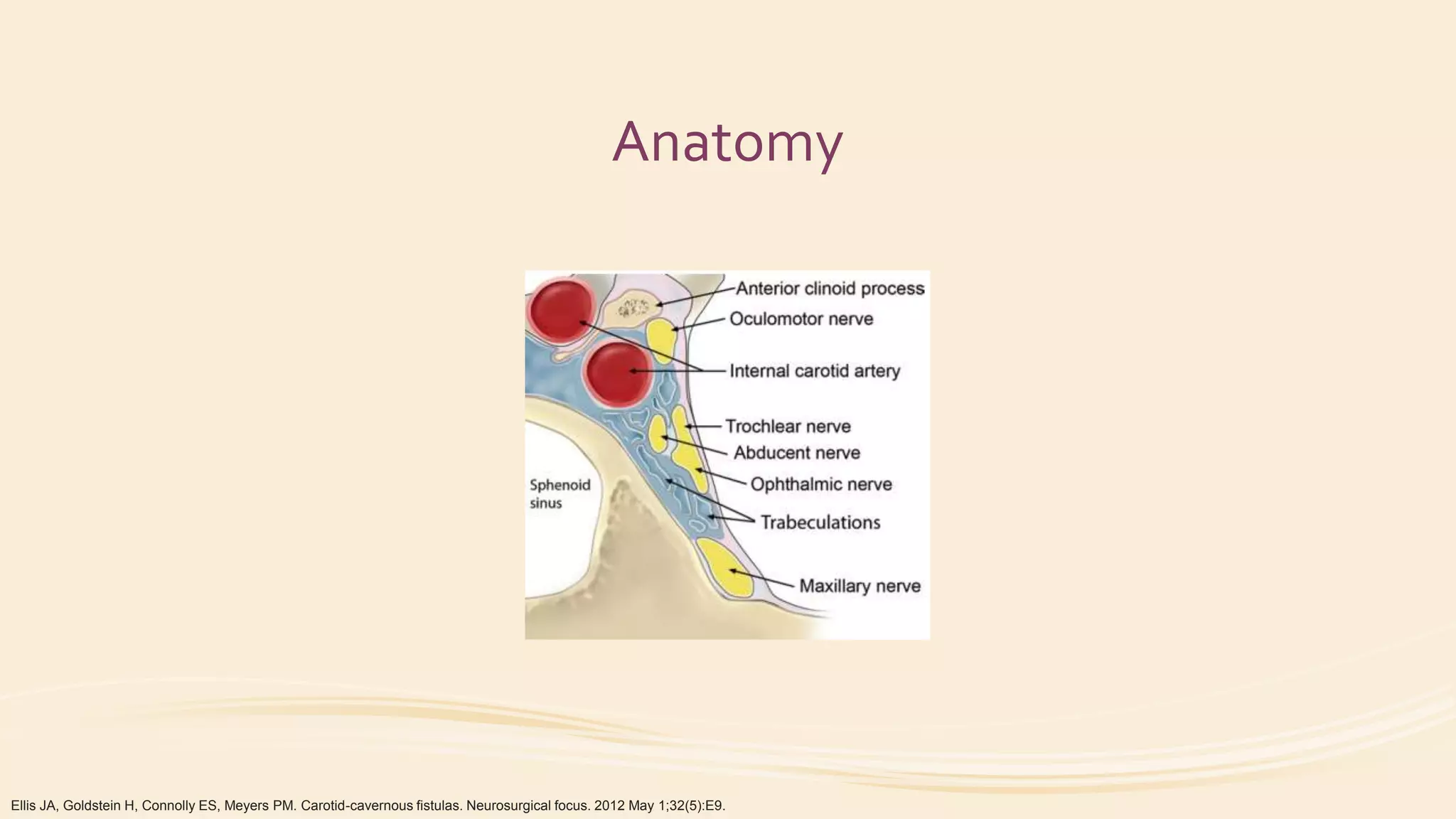 Carotid Cavernous Fistula | PPTX