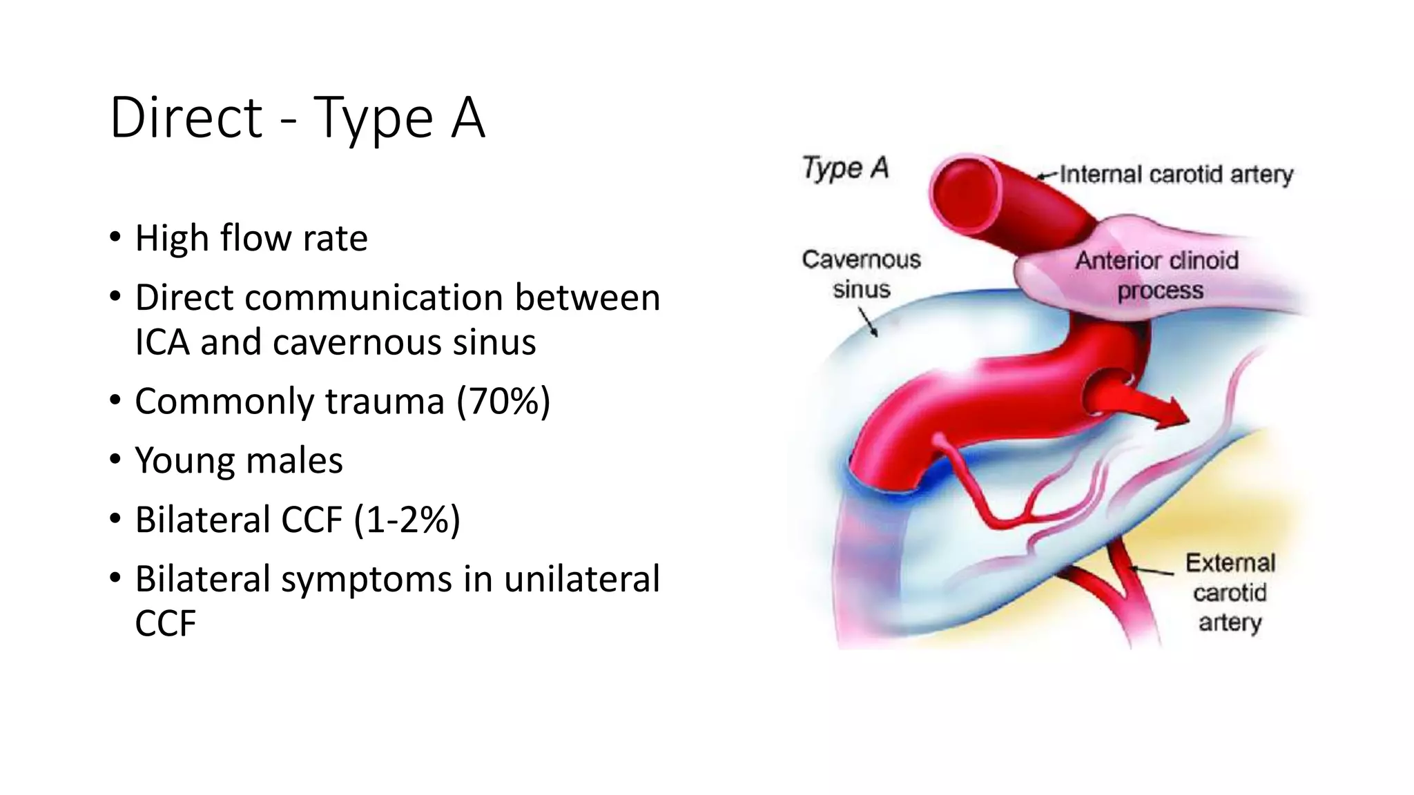 Carotid Cavernous Fistulas | PPTX