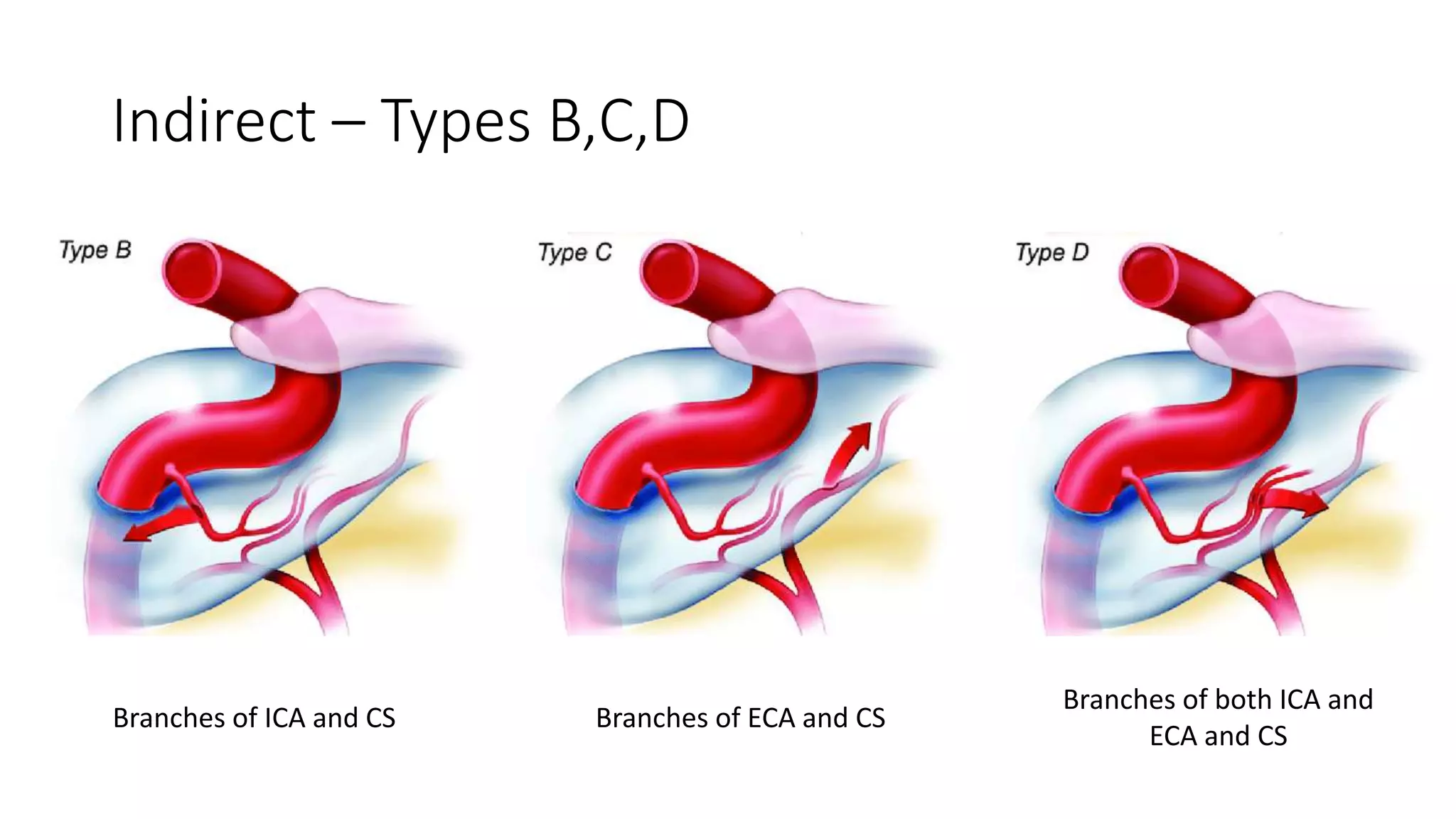 Carotid Cavernous Fistulas | PPTX