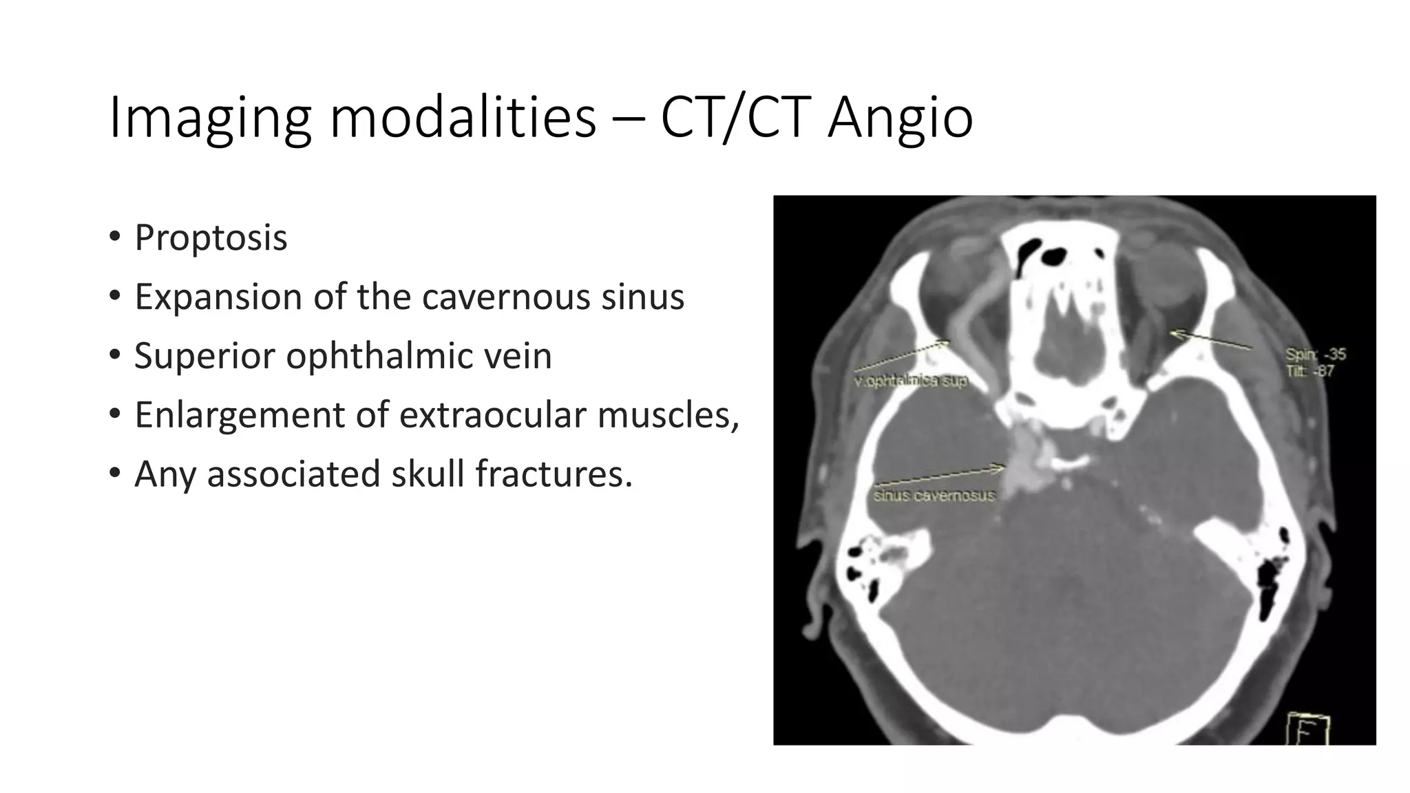 Carotid Cavernous Fistulas | PPTX