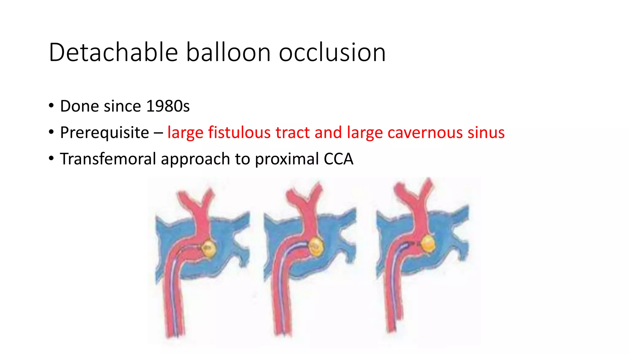 Carotid Cavernous Fistulas | PPTX