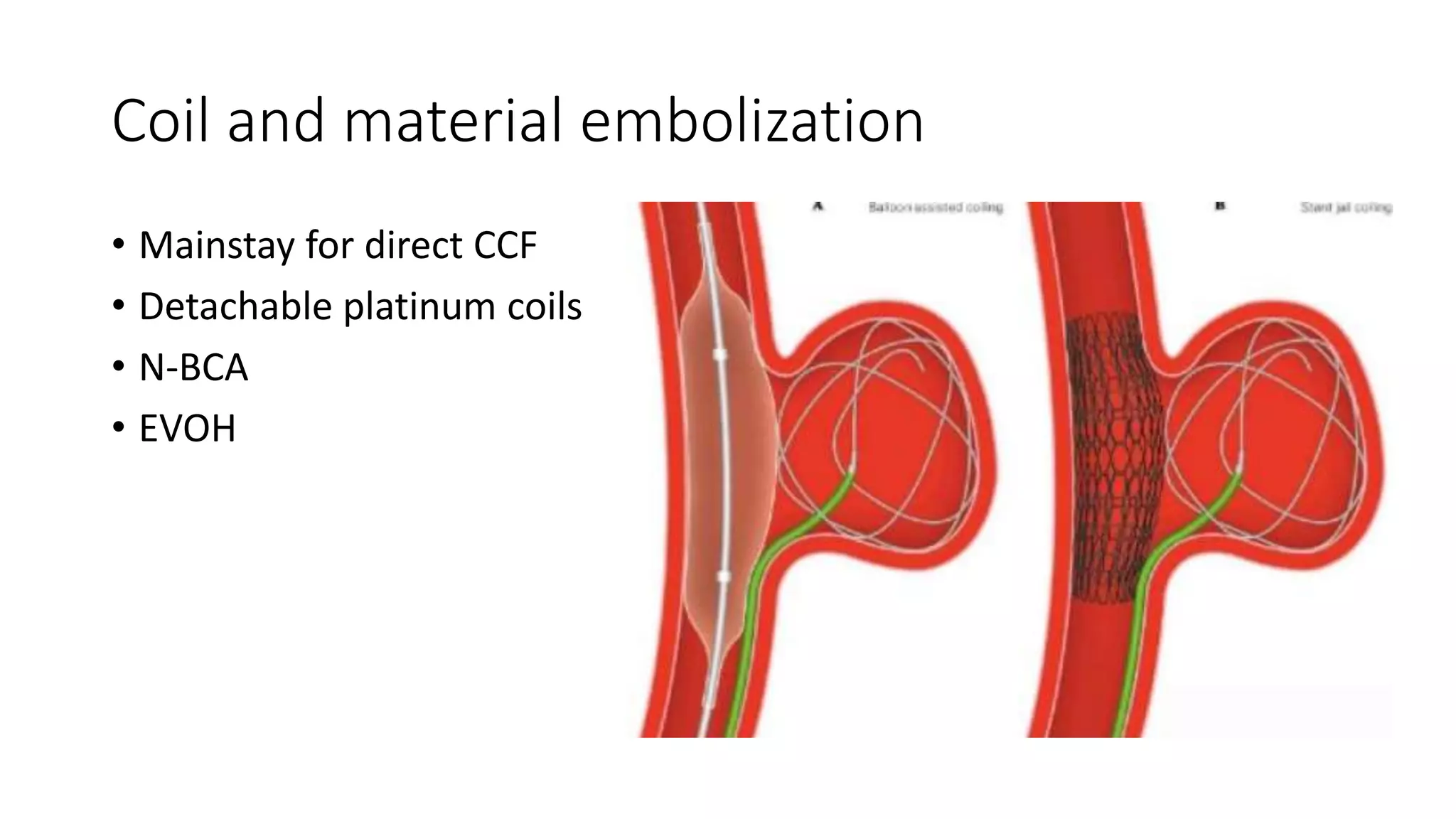 Carotid Cavernous Fistulas | PPTX