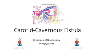 Carotid Cavernous Fistulas | PPTX