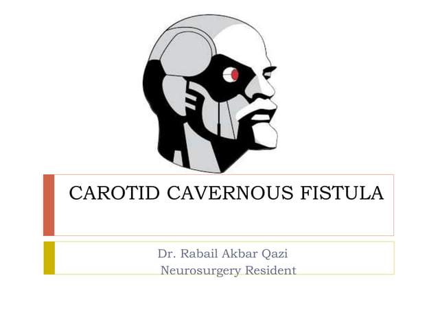 Carotid Cavernous Fistula | PPTX | First Aid | Injuries