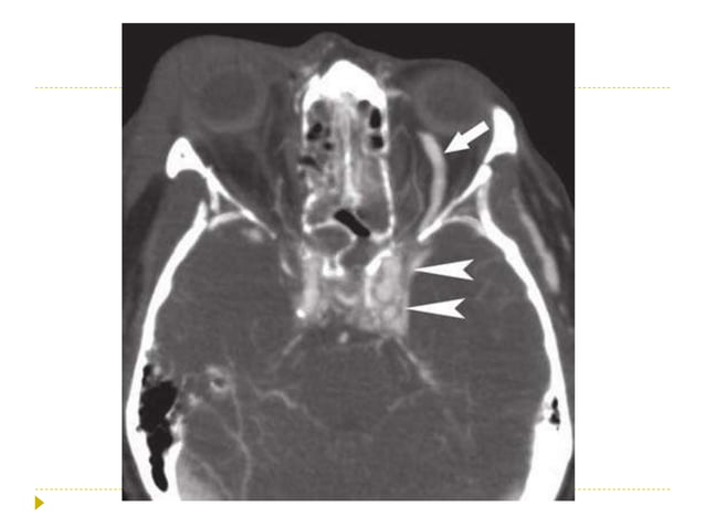 Carotid Cavernous Fistula | PPTX | First Aid | Injuries