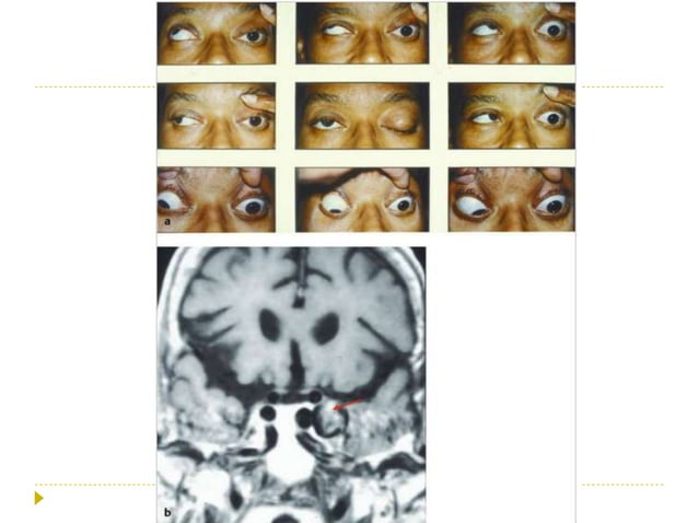 Carotid Cavernous Fistula | PPTX | First Aid | Injuries