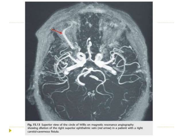 Carotid Cavernous Fistula | PPTX | First Aid | Injuries