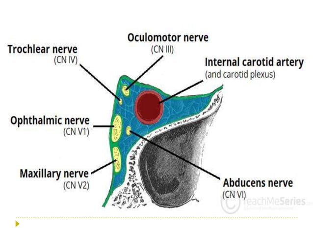 Carotid Cavernous Fistula | PPTX | First Aid | Injuries