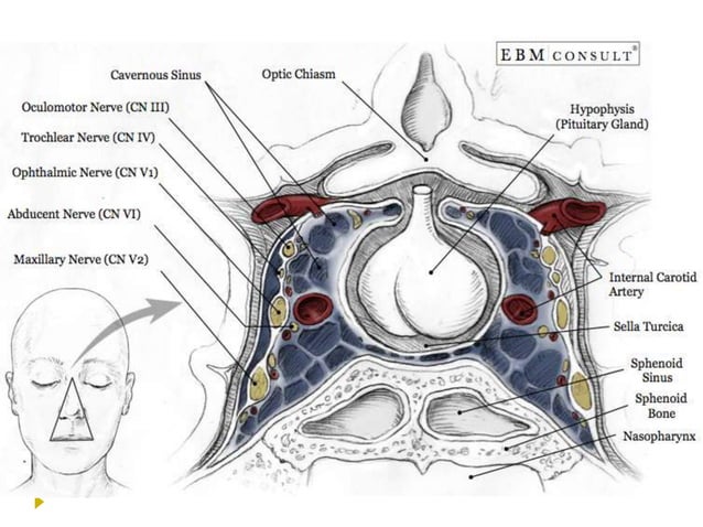 Carotid Cavernous Fistula | PPTX | First Aid | Injuries
