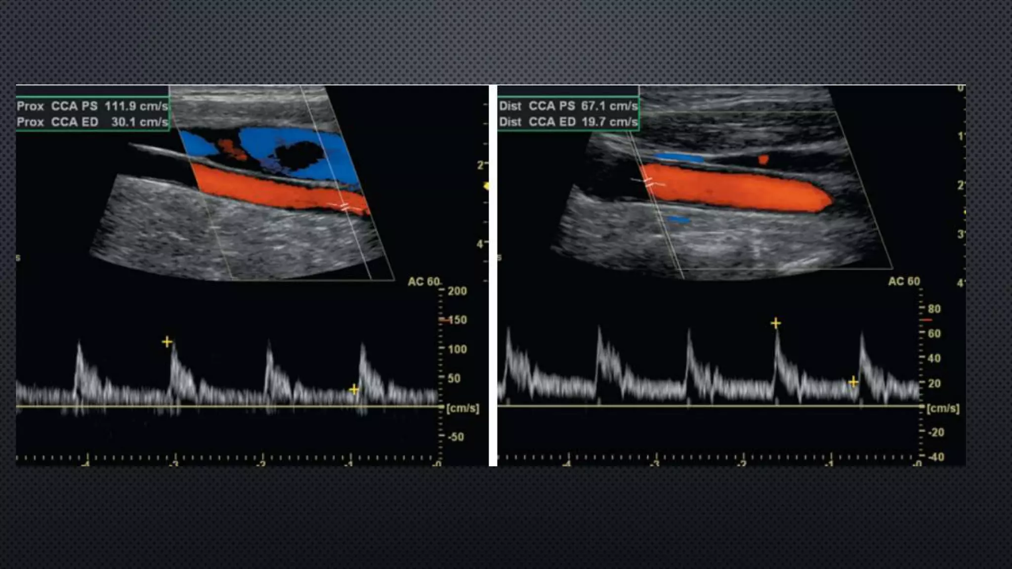 carotid doppler.pptx