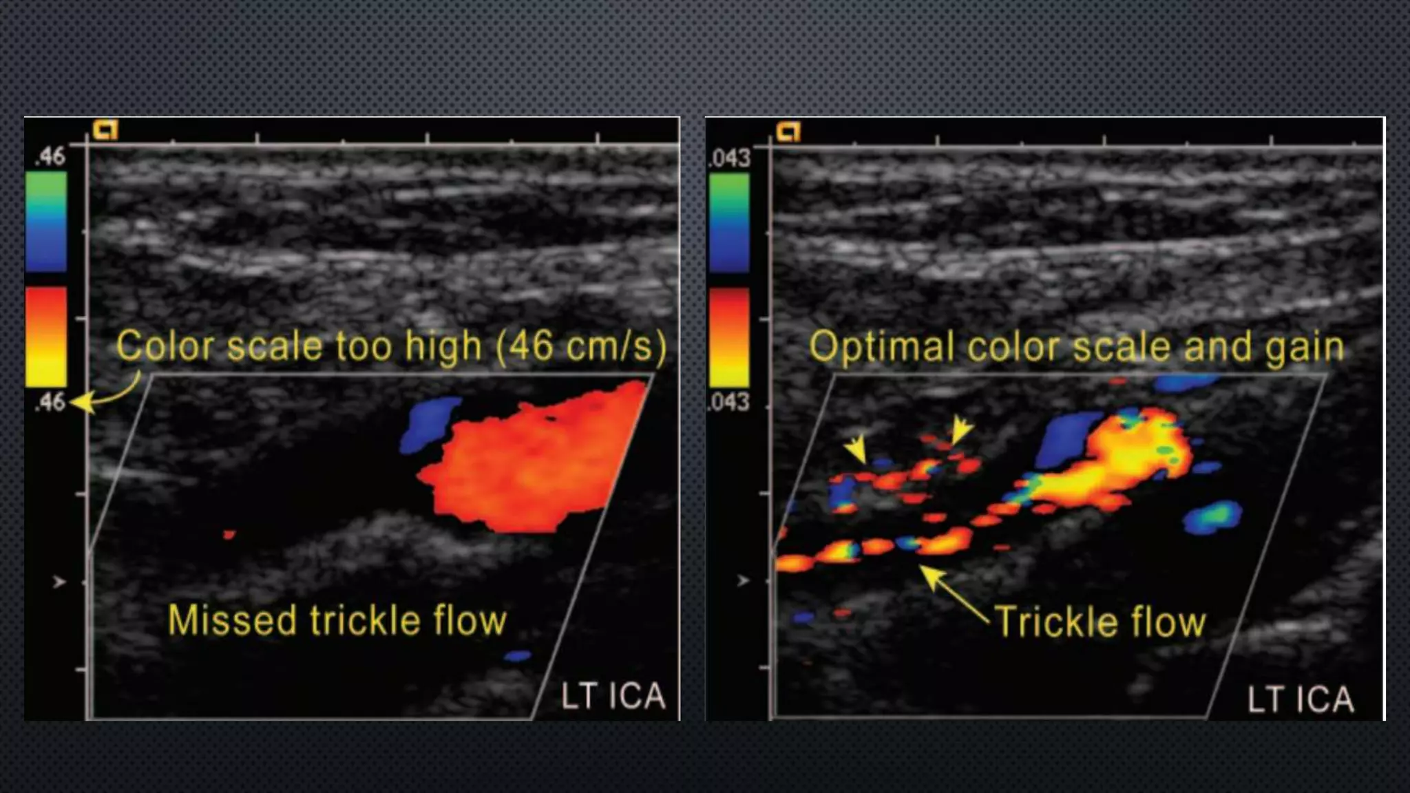 carotid doppler.pptx