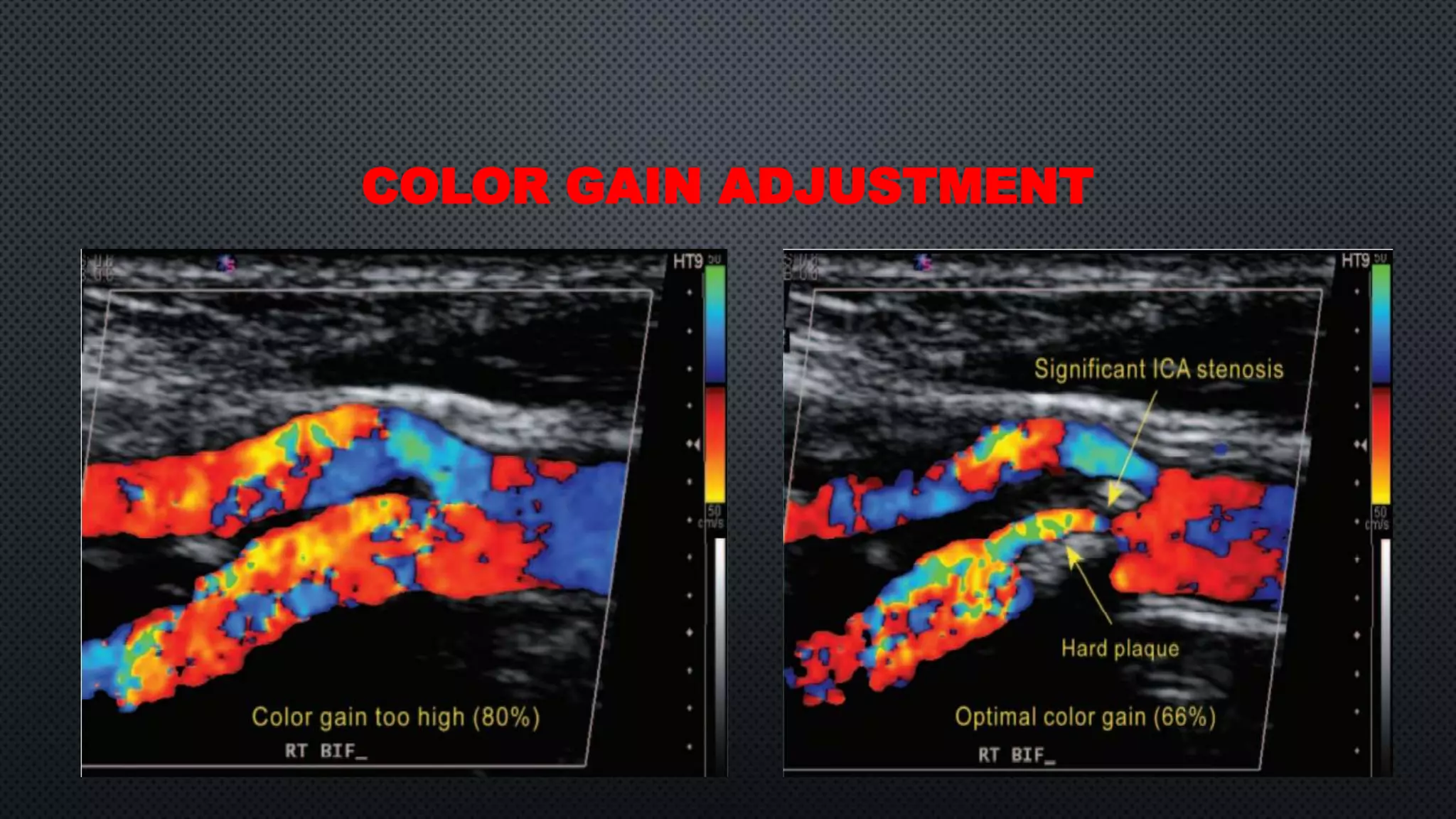 carotid doppler.pptx