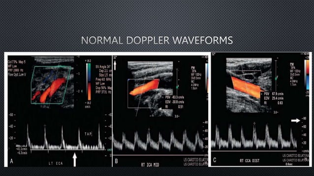 carotid doppler.pptx | Heart and Cardiovascular Diseases | Diseases and ...