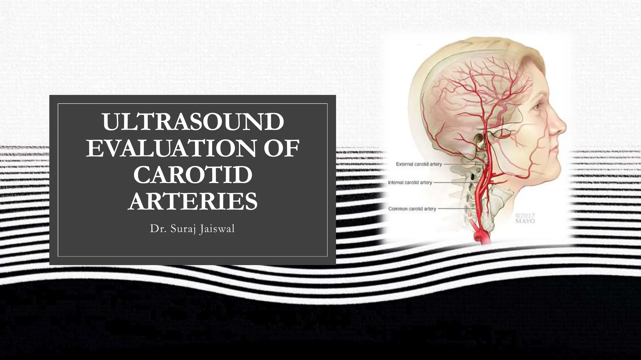 CAROTID DOPPLER BY DR NITIN WADHWANI | PPTX