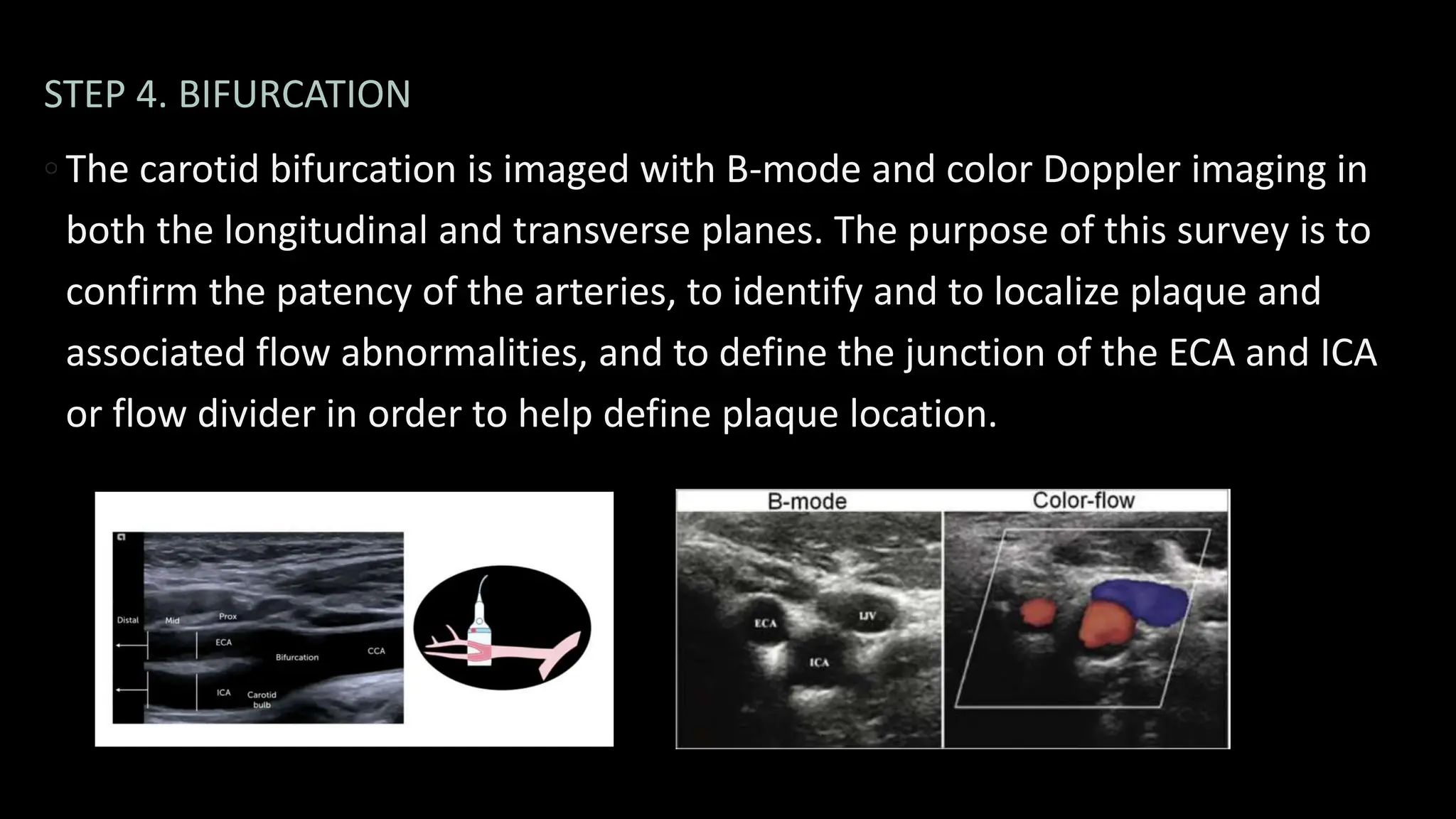 CAROTID DOPPLER BY DR NITIN WADHWANI | PPTX