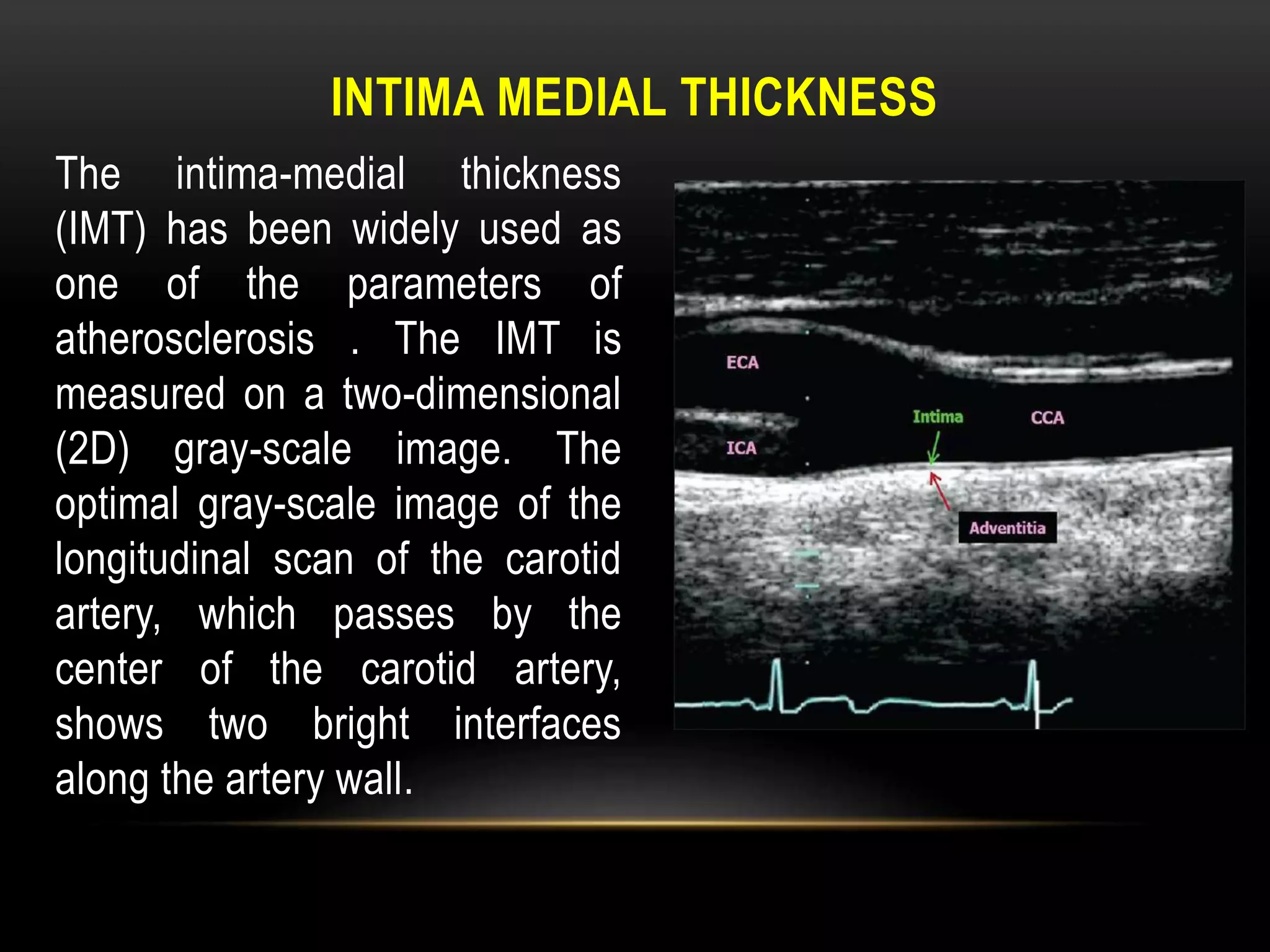 Carotid doppler Ultrasound | PPTX