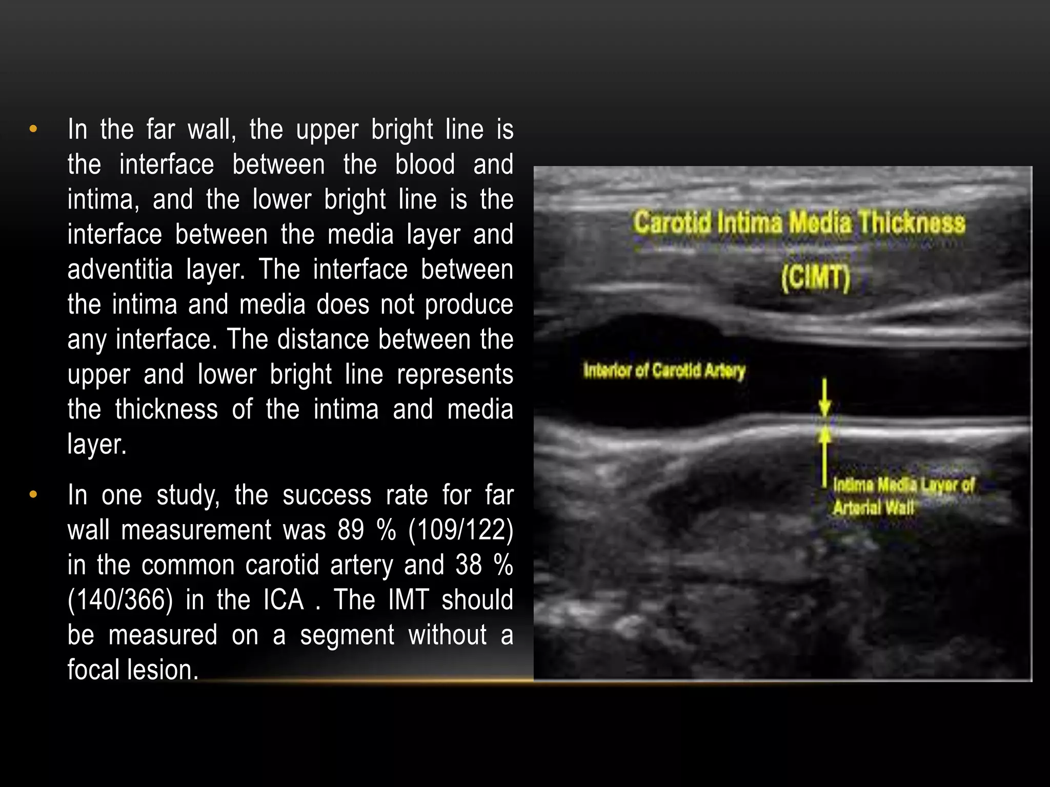 Carotid doppler Ultrasound | PPTX