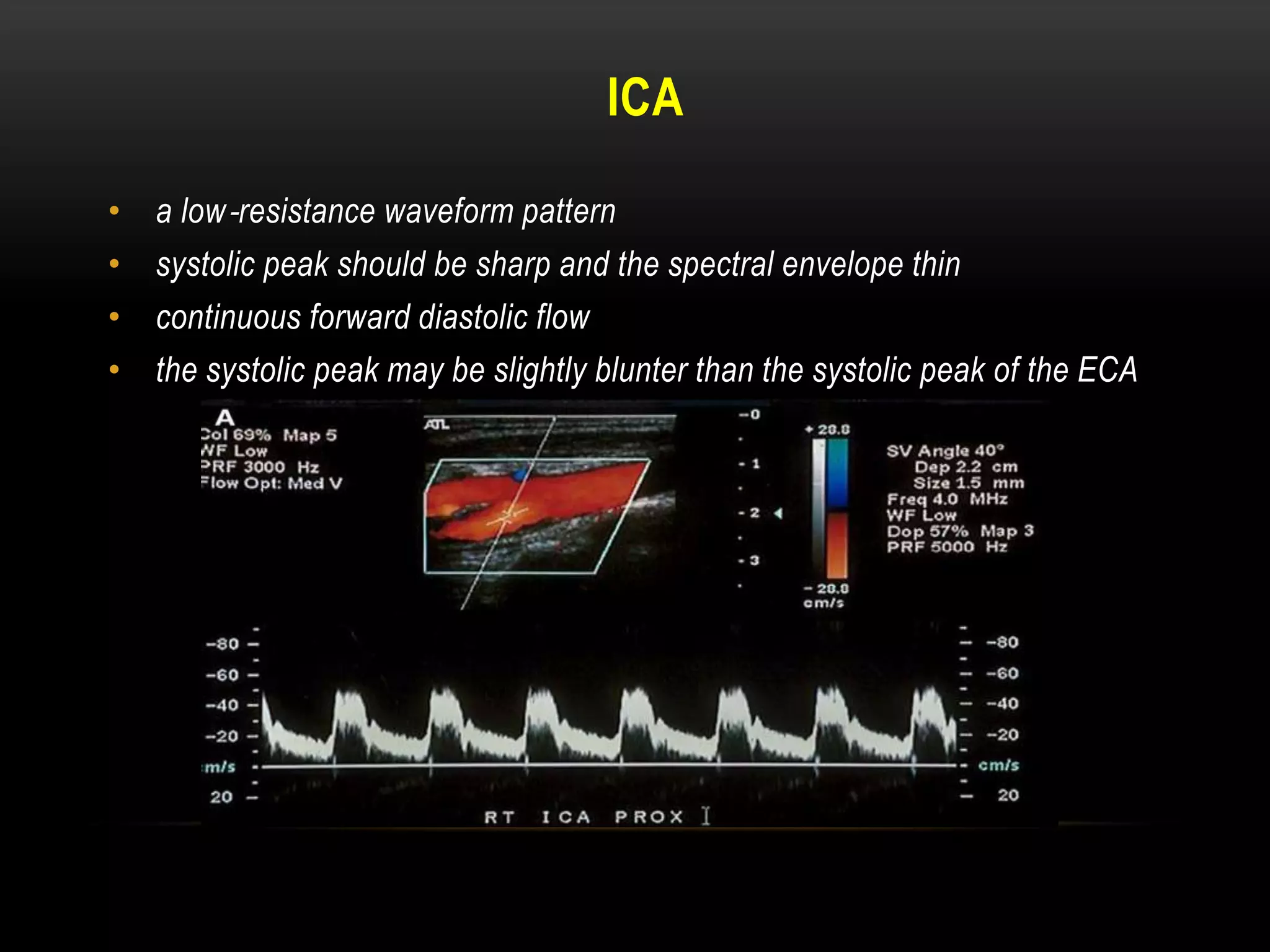 Carotid doppler Ultrasound | PPTX