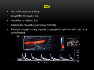 Carotid doppler Ultrasound | PPTX