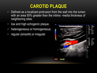 Carotid doppler Ultrasound | PPTX