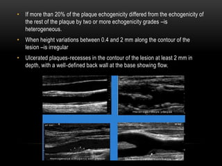 Carotid doppler Ultrasound | PPTX