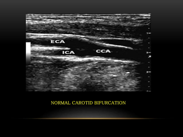 Carotid doppler Ultrasound | PPTX
