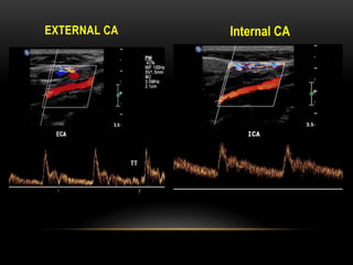 Carotid doppler Ultrasound | PPTX