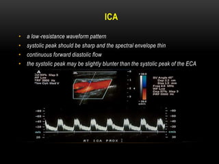 Carotid doppler Ultrasound | PPTX