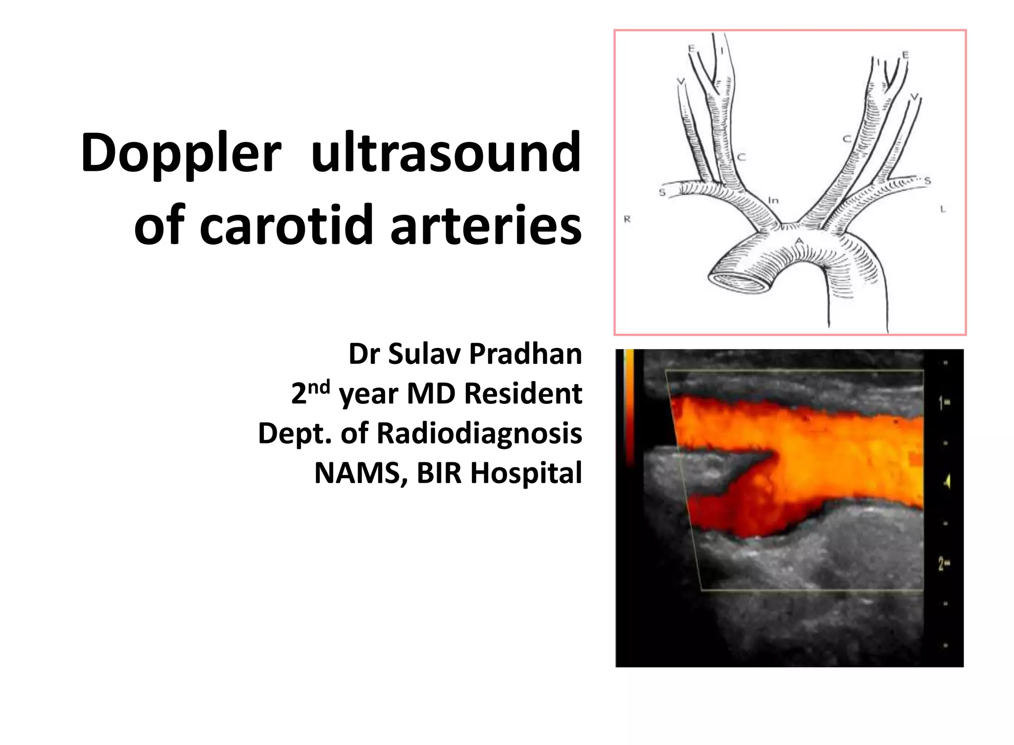 Carotid Doppler | PPT